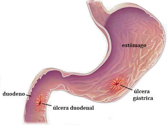 Úlcera Gástrica e Úlcera Duodenal - Dr. Paulo Pittelli